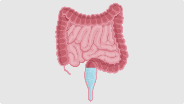 Peristeen Light - Laag volume transanale irrigatie - Informatie voor ...